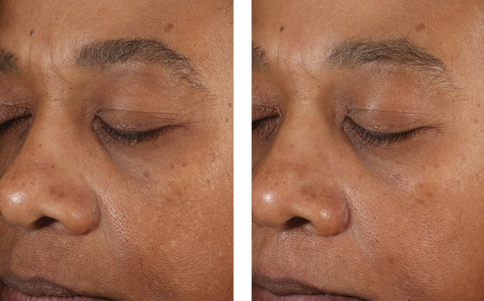 Antioxidant & Retinoid | A-Team Duo Kit | skinbetter science