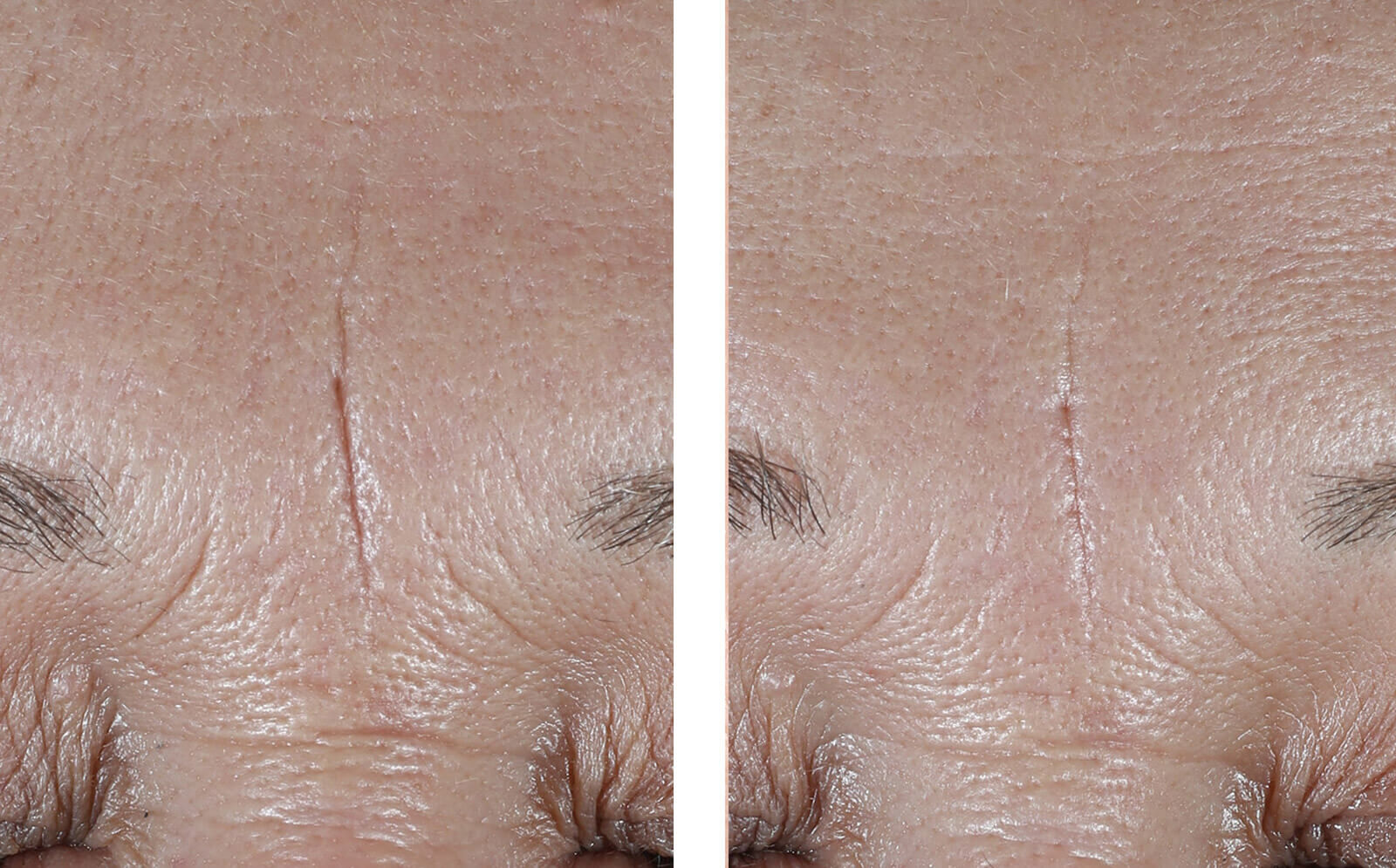 InterFuse Treatment Cream FACE & NECK | skinbetter science