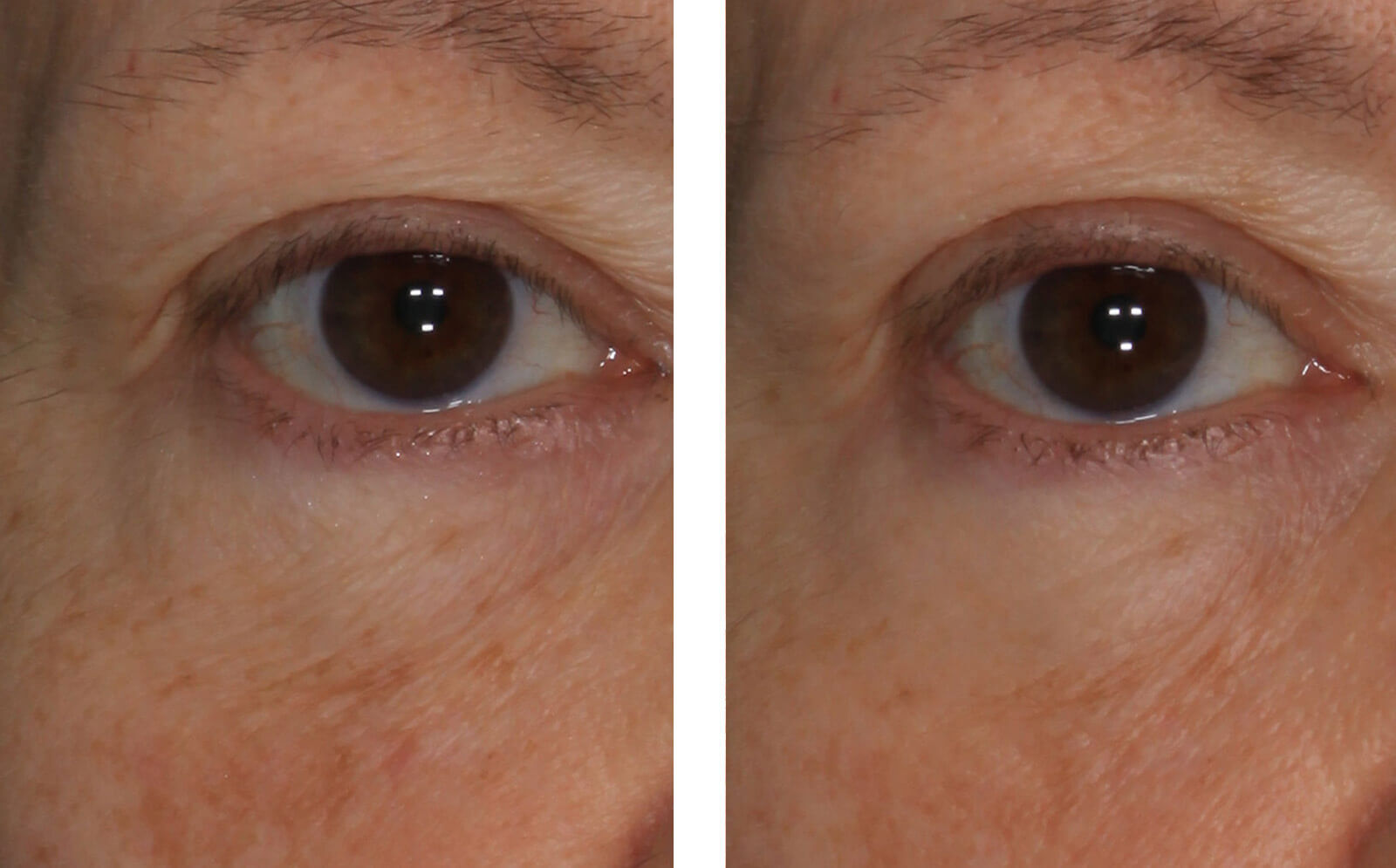 InterFuse Treatment Cream EYE | Eye Care | skinbetter science