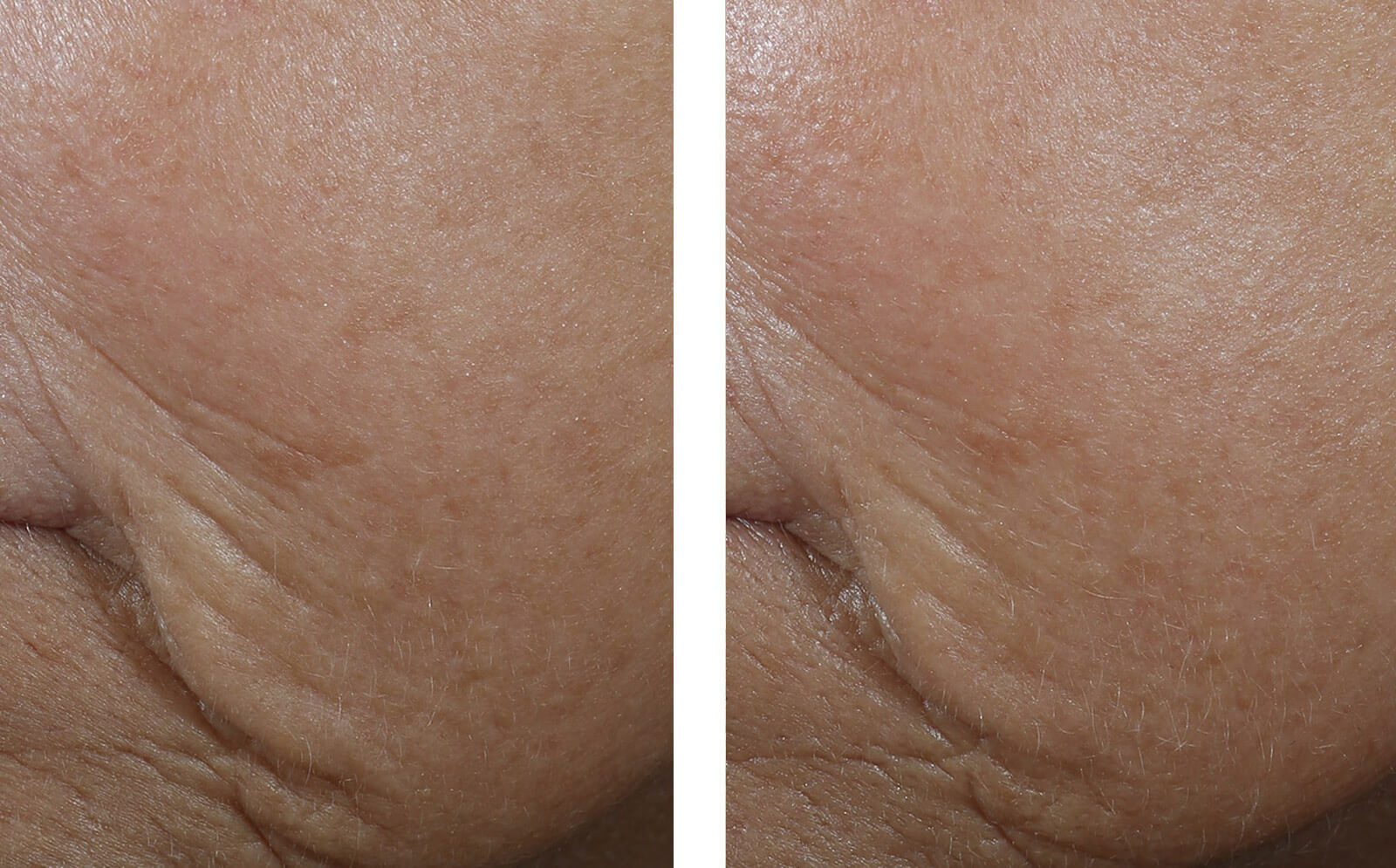 InterFuse Treatment Cream FACE & NECK | Anti-Aging | skinbetter science