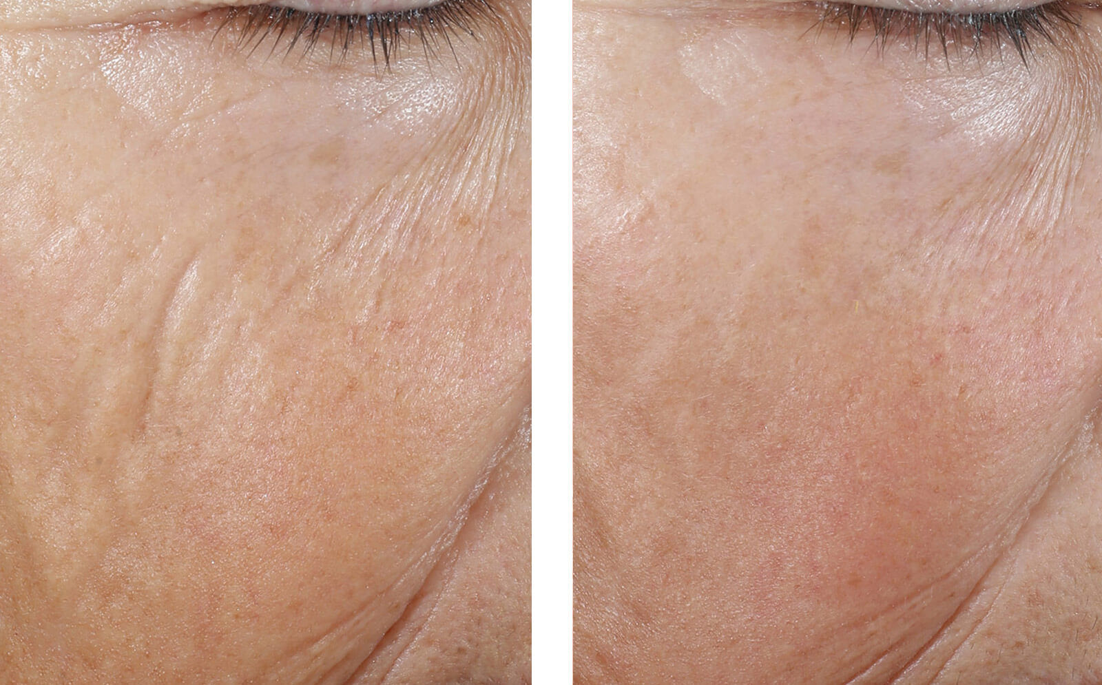 InterFuse Intensive Treatment LINES | Anti-Aging | skinbetter science