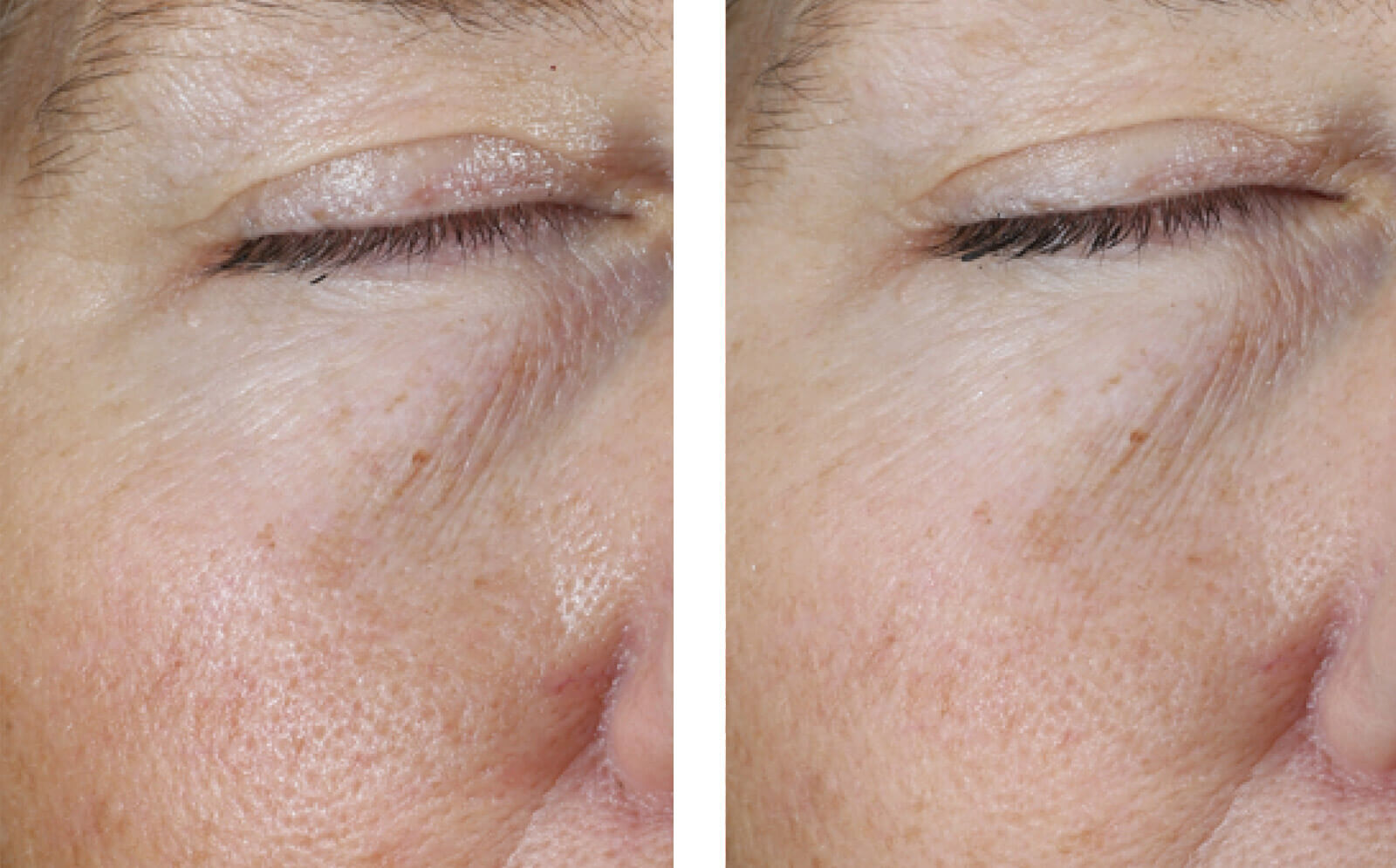 Instant Effect Gel EYE | Eye Care | skinbetter science